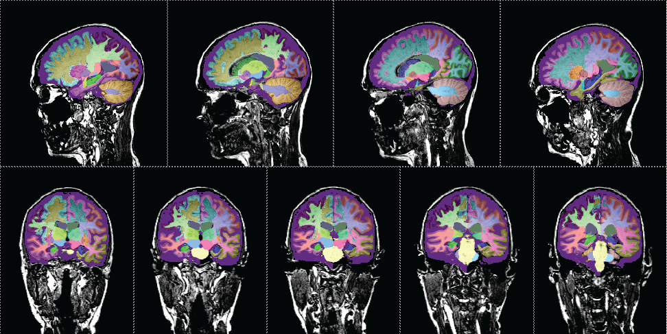 Brainreader | AI-Enabled Brain Volumetric Analysis