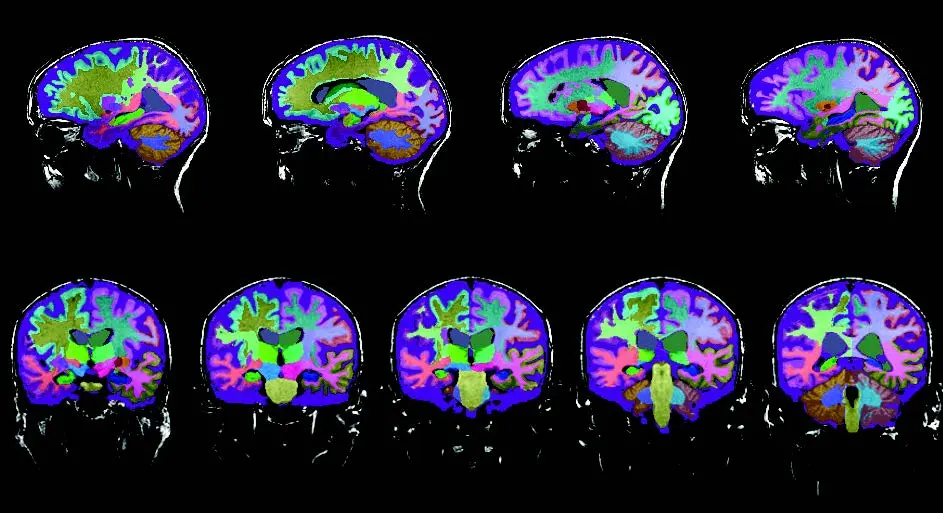 Quantitative MRI (qMRI): What It Is & Why It Matters in Modern Neuroim